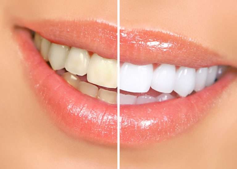 Professional Teeth Whitening Services in NYC - Magic Smile